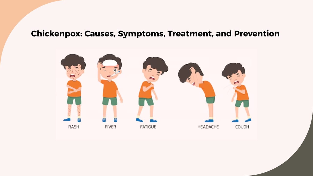 Chickenpox: Causes, Symptoms, Treatment & Prevention | MVD Pharmacy